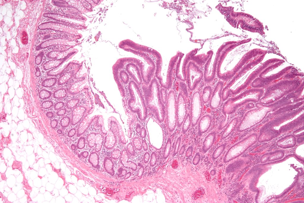 Apoptosis – Pathologia