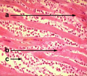 Necrosis – Pathologia