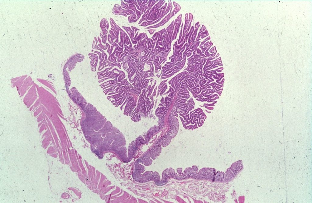 Neoplasia – definition, nomenclature and spread – Pathologia