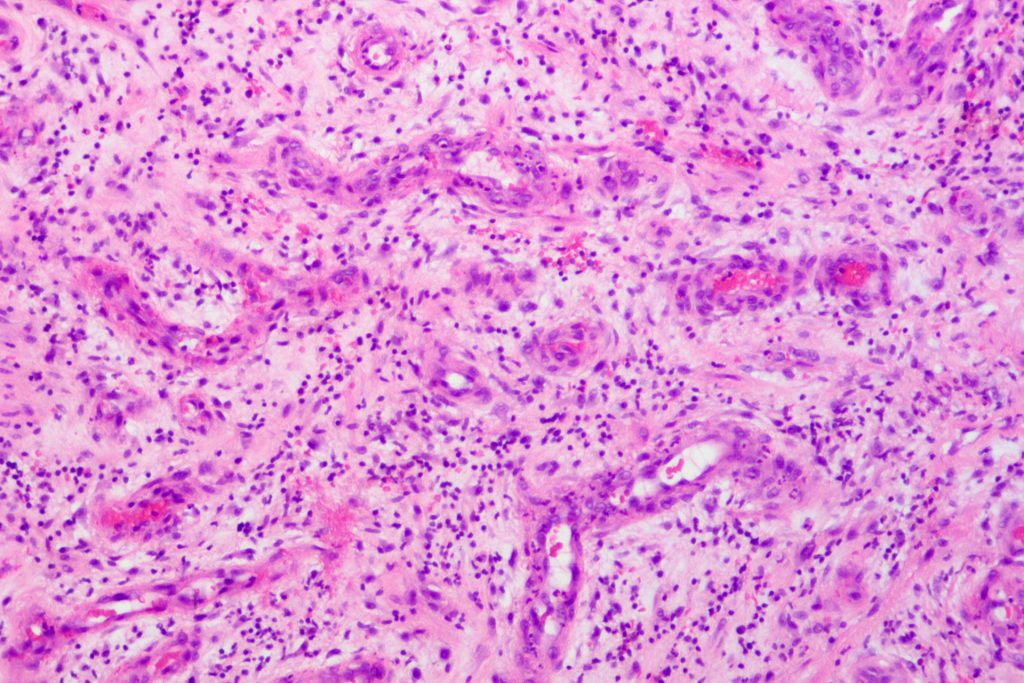 Wound healing – regeneration and scarring – Pathologia