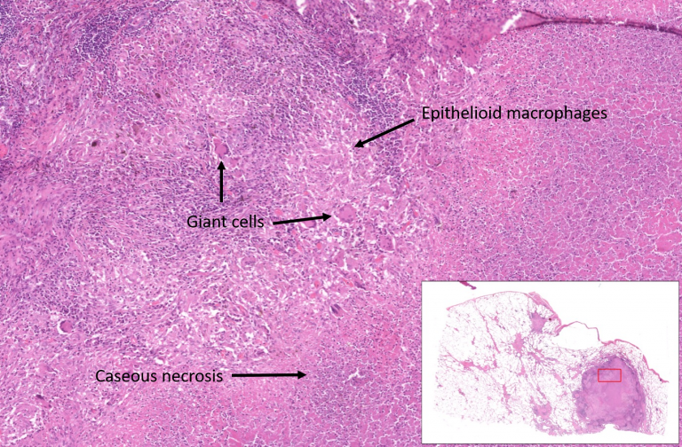 Necrosis – Pathologia