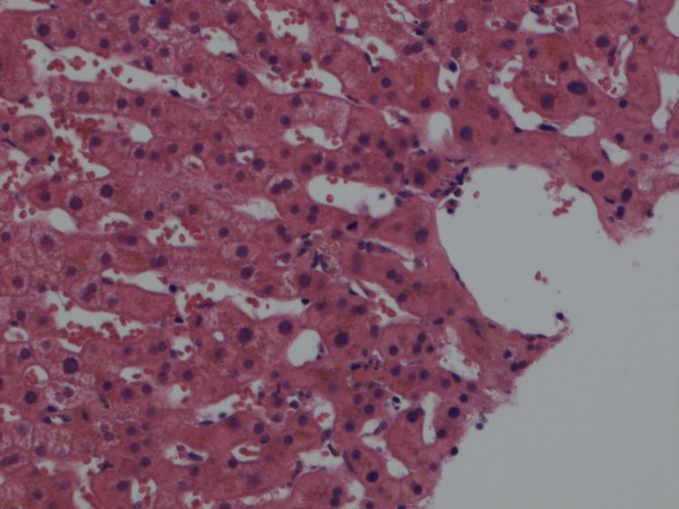 Necrosis – Pathologia