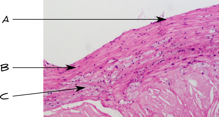 Atherosclerosis and atheroma – Pathologia