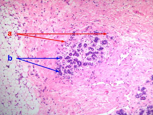 Malignant Breast Disease – Pathologia