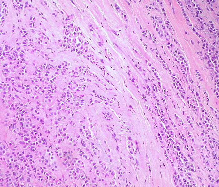 Malignant Breast Disease – Pathologia