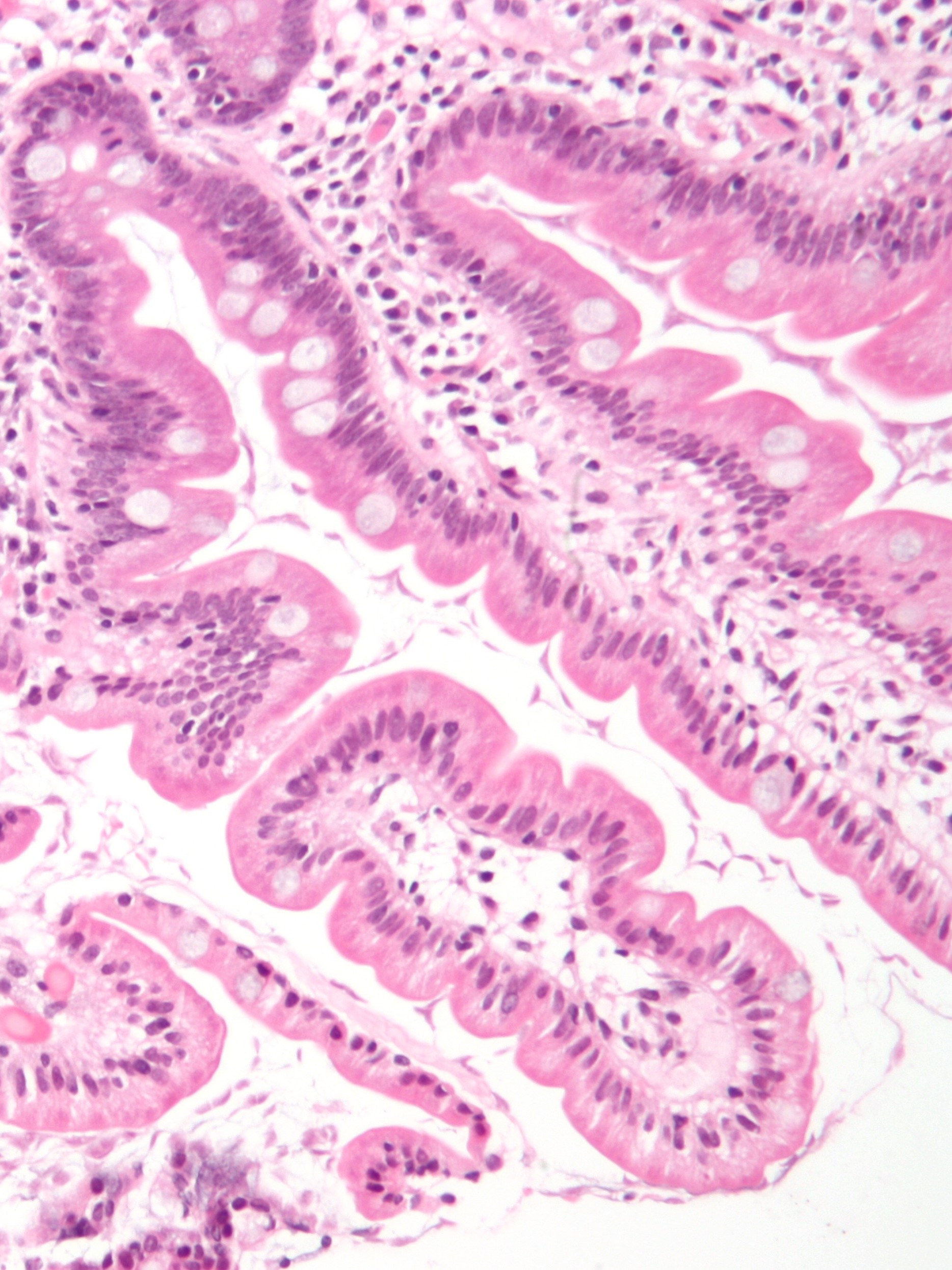 GI – Duodenum and Small Bowel – Pathologia
