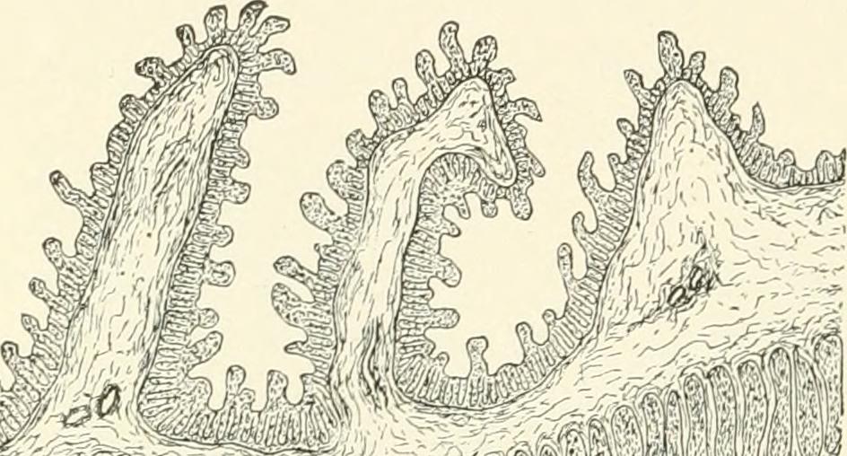 GI – Duodenum and Small Bowel – Pathologia